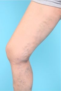 Why are varicose veins blue and green? | Canada Vein Clinics
