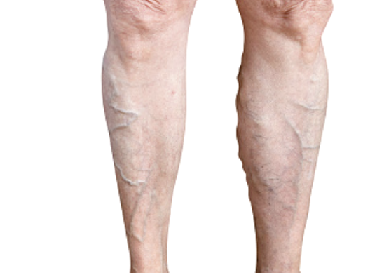 Why are Varicose Veins more common on the legs? | Canada Vein Clinics